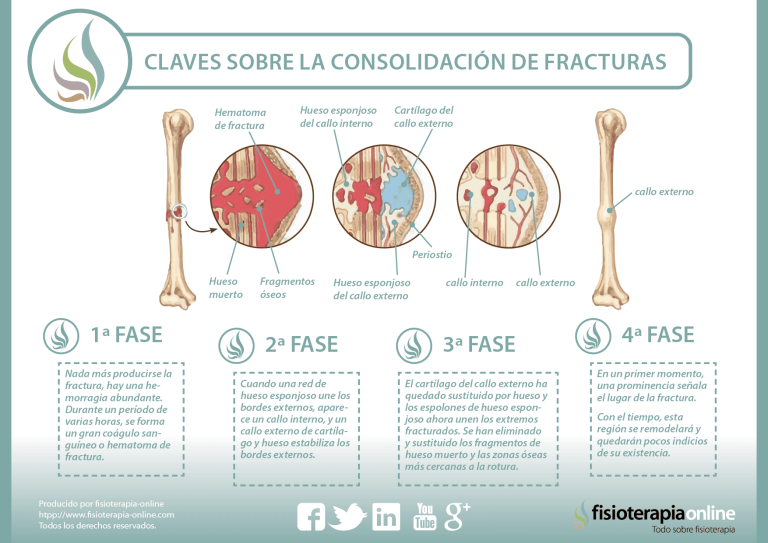 Descubre los signos y tratamientos para una fractura: guía completa